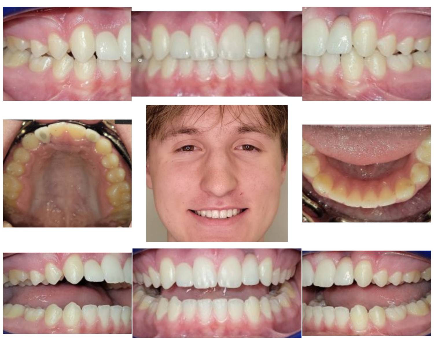 Invisalign Patient 2 - Dental By Design