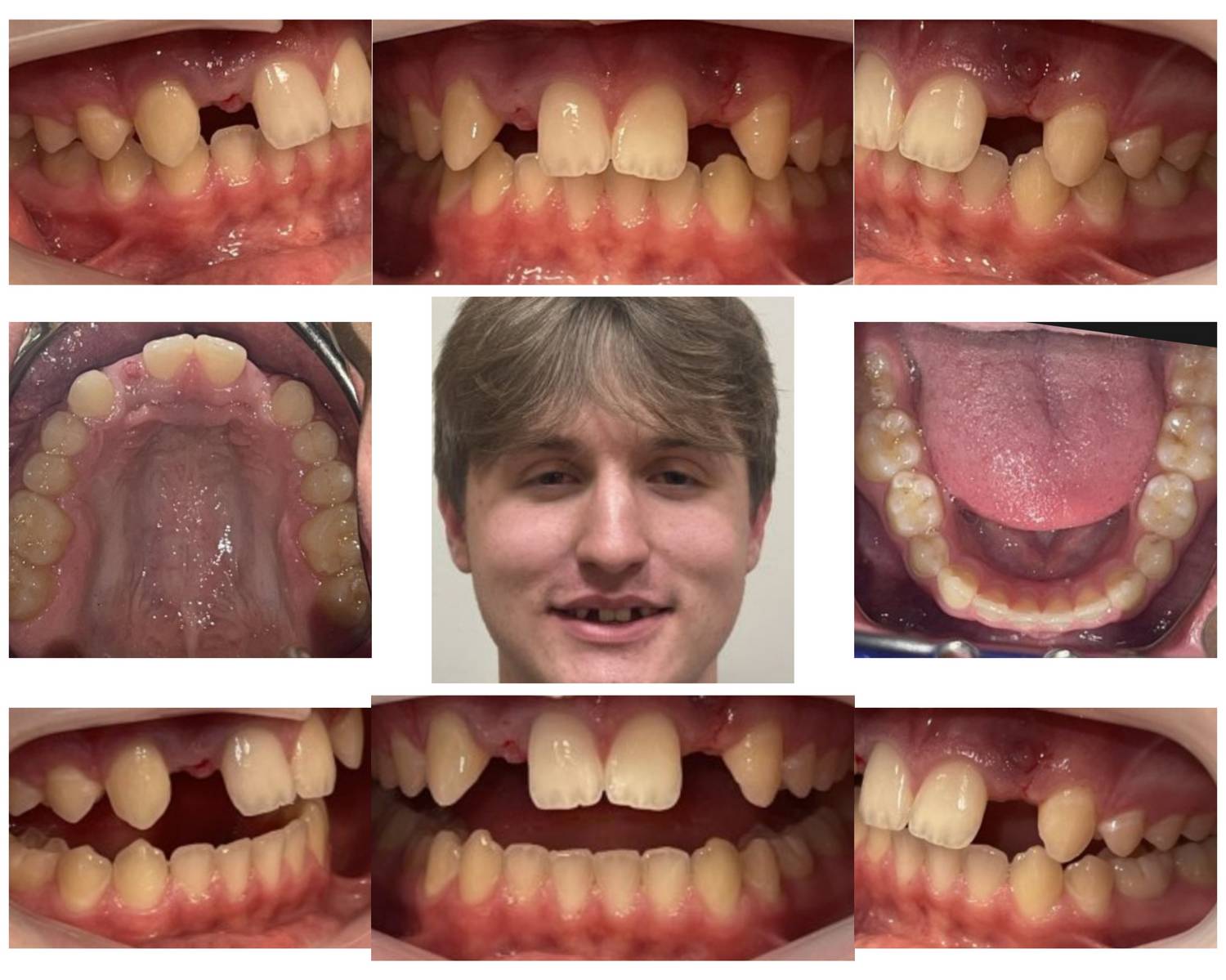 Invisalign Patient 2 - Dental By Design